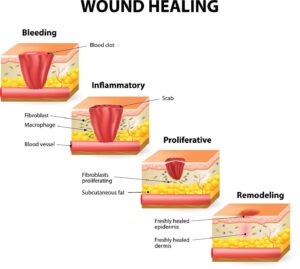 Understanding Basics of Wound Healing in San Antonio, TX